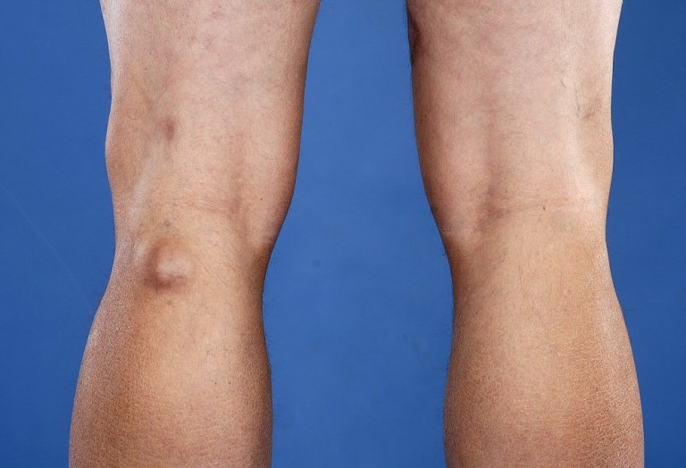 What Is A Baker s Cyst What Is A Baker s Cyst